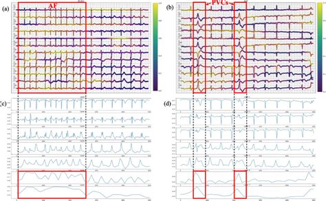 Estimating Critical Values From Electrocardiogram Using A Deep Ordinal Convolutional Neural