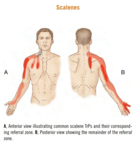 Physiotherapy PALPATION TECHNIQUES AND TRIGGER POINTS OF SOME IMPORTANT MUSCLES
