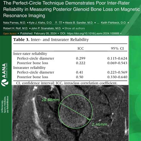 Arthroscopy Journals On Linkedin Posterior Glenoid Bone Loss The Perfect Circle Technique For