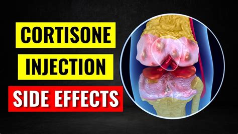 The Single Worst Side Effect Of Cortisone Shots Youtube