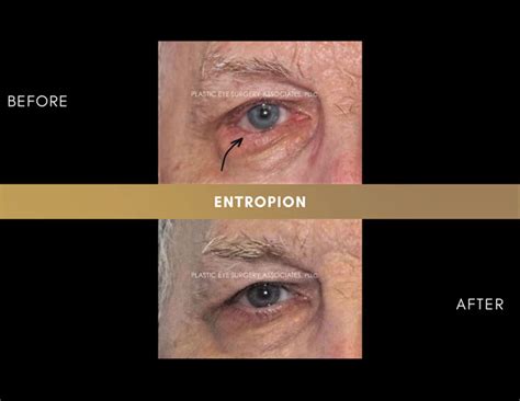 Ectropion Entropion Photos Plastic Eye Surgery Associates