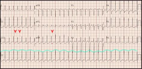 Pediatric Svt Ecg