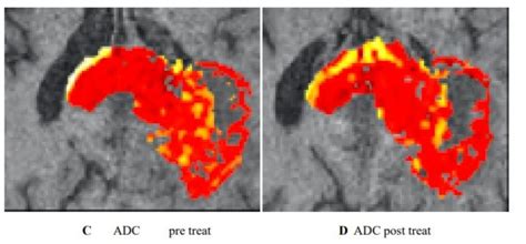 Programmed Response Evaluation And Prediction Of Gbms Using Artificial