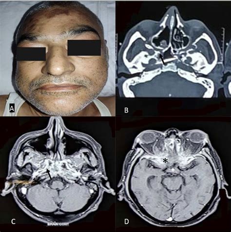 A Bilateral Ptosis B Cect Brain Revealed Erosion Of Sphenoid Bone Download Scientific Diagram