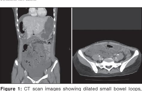 Table 1 From Large Congenital Mesenteric Defect Presenting In An Adult Semantic Scholar