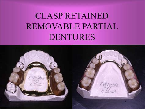 Types Of Removable Partial Denture Clasps At Maria Brittain Blog