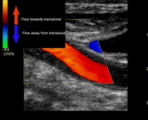 DOPPLER INSTRUMENTATION Flow Flashcards Quizlet