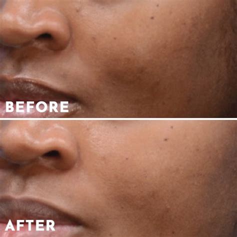 Moxi Laser Infinite Youth Medical