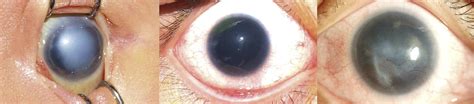 Corneal Abnormalities In Congenital Aniridia Congenital Central