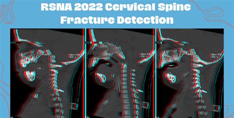 Rsna Fracture Detection Kaggle