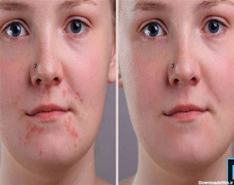 عکس صورت جوش دار برای روتوش