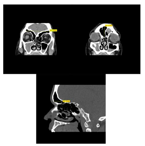 Frontal Sinus Morphological And Dimensional Variation As Seen On