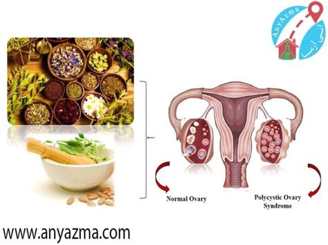 درمان قطعی سندرم تخمدان پلی کیستیک با گیاهان دارویی آنی آزما