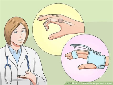 How To Treat Mallet Finger With A Splint Steps With Pictures