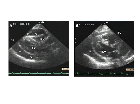 Subxiphoid Pericardial Window