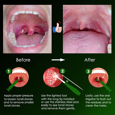 Giant Tonsilloliths Tonsil Stones Wikipedia