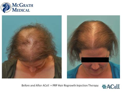 Acell Prp Hair Regrowth Injection Therapy Austin Houston And Dallas