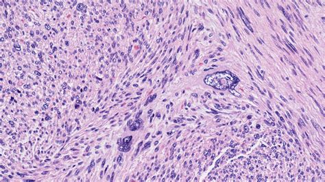 Leiomyosarcoma Atlas Of Pathology