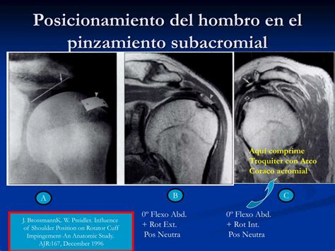 Ppt Rehabilitación De Hombro Y Síndrome Del Pinzamiento Subacromial