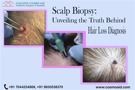 Scalp Biopsy Unveiling The Truth Behind Hair Loss Cosmoaid