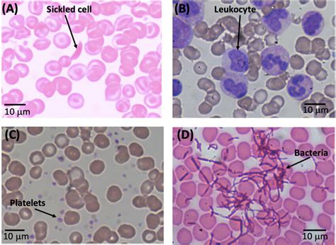 Sickle Cell Anemia Under Microscope Sickle Cell Disease Scd Workup