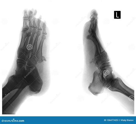 X Ray Of The Foot Exostosis Of The 5th Metatarsal Bone Negative Stock