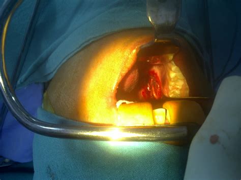 Ent Surgeons Blog Elongated Styloid Process Excision