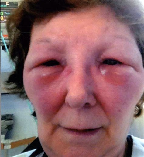 Fake Doctor Left Woman With A Frozen Face After Botched Botox Metro News