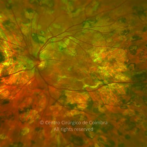 Caso Clínico 1 Atlas Rl Eye