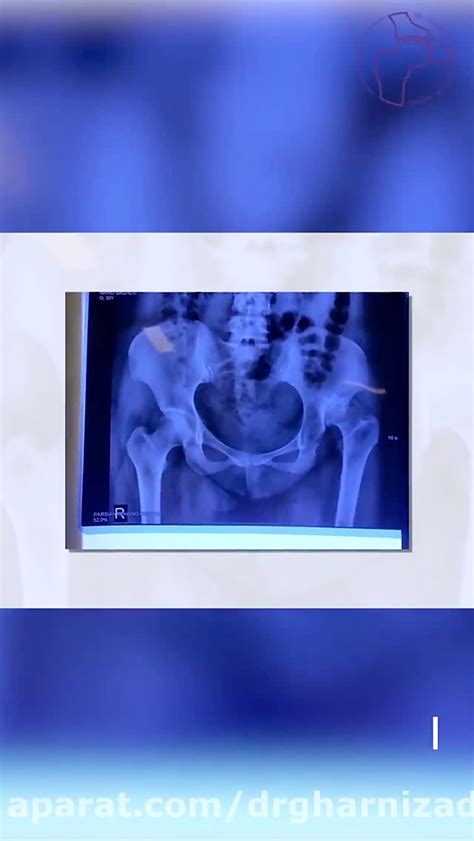 تعویض مفصل ران