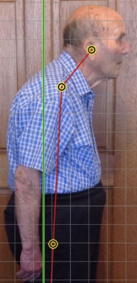 Forward Head Posture The Spinal Centre