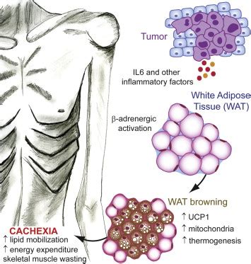Cachexia Researching The Wasting Disease AG Blog