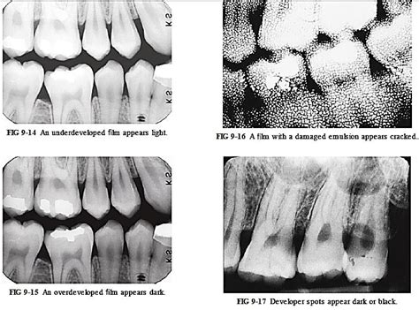 Digital Dental X Ray Errors At Dennis Marquis Blog