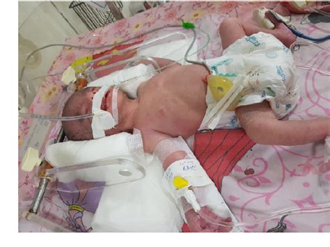 Figure 1 From A Rare Case Of Dandy Walker Syndrome With Bilateral