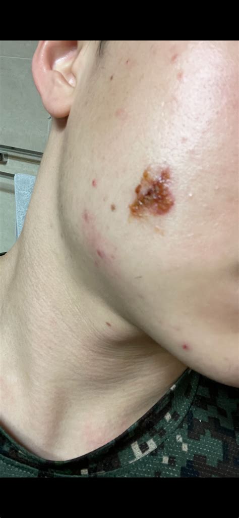 피부 질문 얼굴 상처 지식in