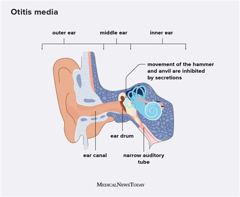 Otitis Media