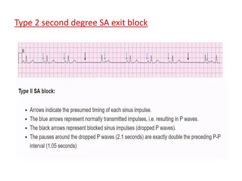 Sinus Node Dysfunction Pptx