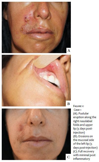 Surgical And Cosmetic Dermatology Pustular Rash After Dermal Filler Injection Should Not Be