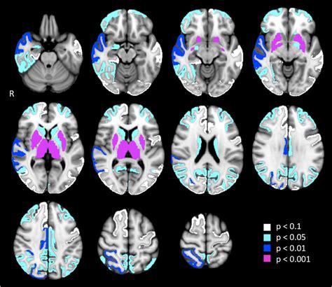 Average Mean Diffusivity Md In Sporadic Creutzfeldt Jakob Disease