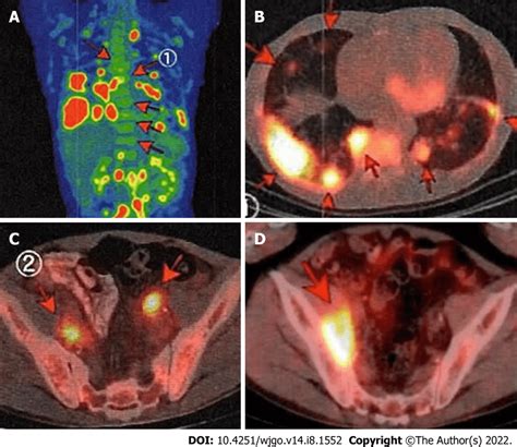 Positron Emission Tomography Computed Tomography Imaging Of Case 5 Download Scientific Diagram
