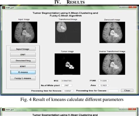 Figure 4 From Brain Tumor Segmentation And Area Calculation Of Tumor By Use Of Unsupervised