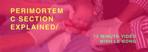 Explained Perimortem C Section By Minh Le Cong Intensive Care Network