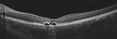 A En Face Oct At The Level Of Rpe Reveals Two Hyporeflective Areas