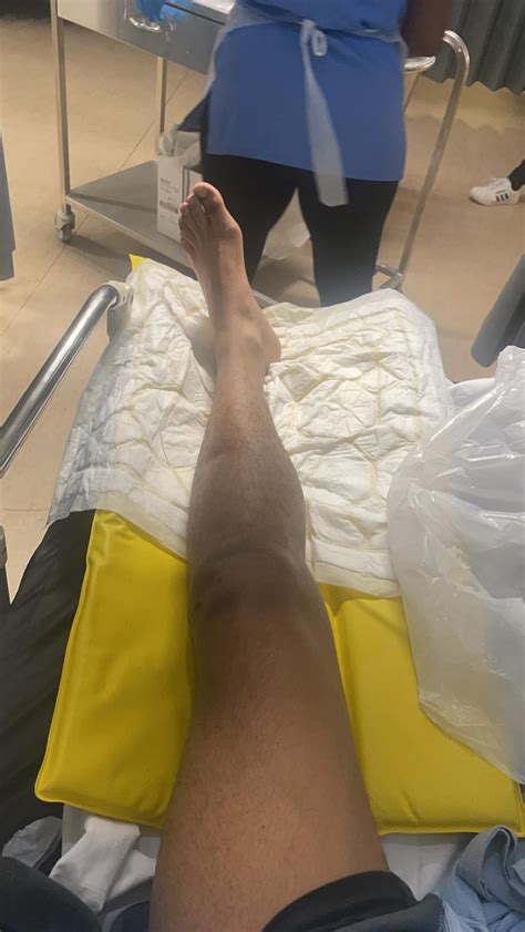 Broken Tibia R Brokenbones