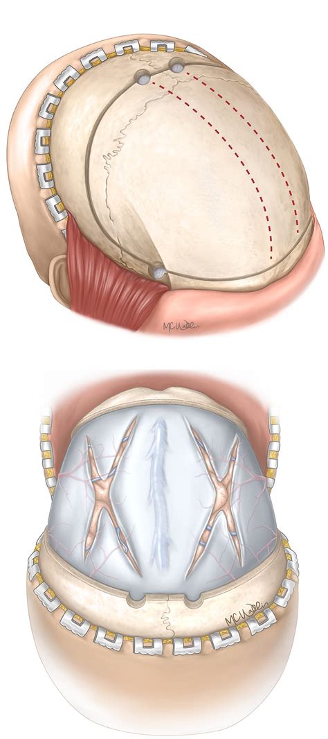 The Bifrontal Craniotomy Or The Neurosurgical Atlas Facebook