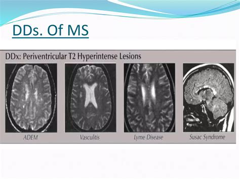 Radiology Of Demyelinating Diseases Pptx