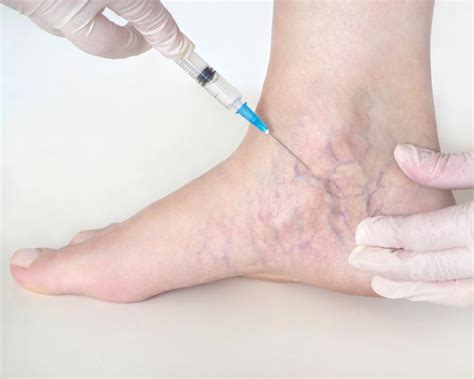 Spider And Varicose Veins Treatments Sclerotherapy Faqs Vein Center