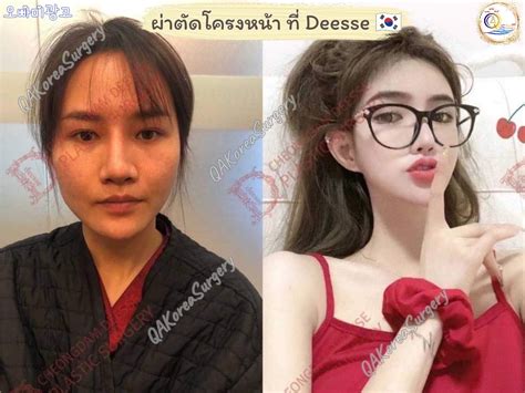 รีวิว ผ่าตัดโครงหน้า ศัลยกรรมเกาหลี Qa Korea Surgery