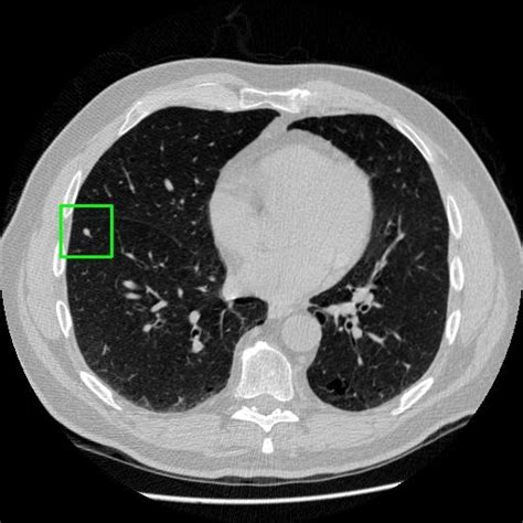 Internship DL Lung Nodules Detection Object Detection Dataset V2 2023