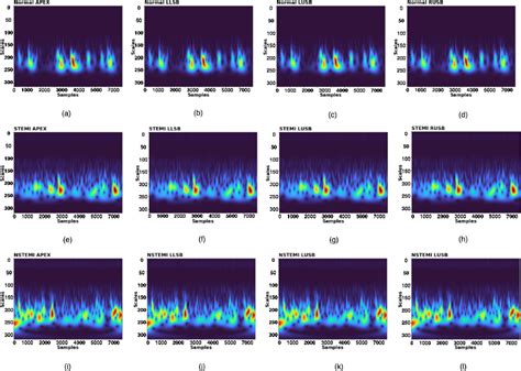 Figure 1 From Automated Classification Of Myocardial Infarction Based On Auscultation Position